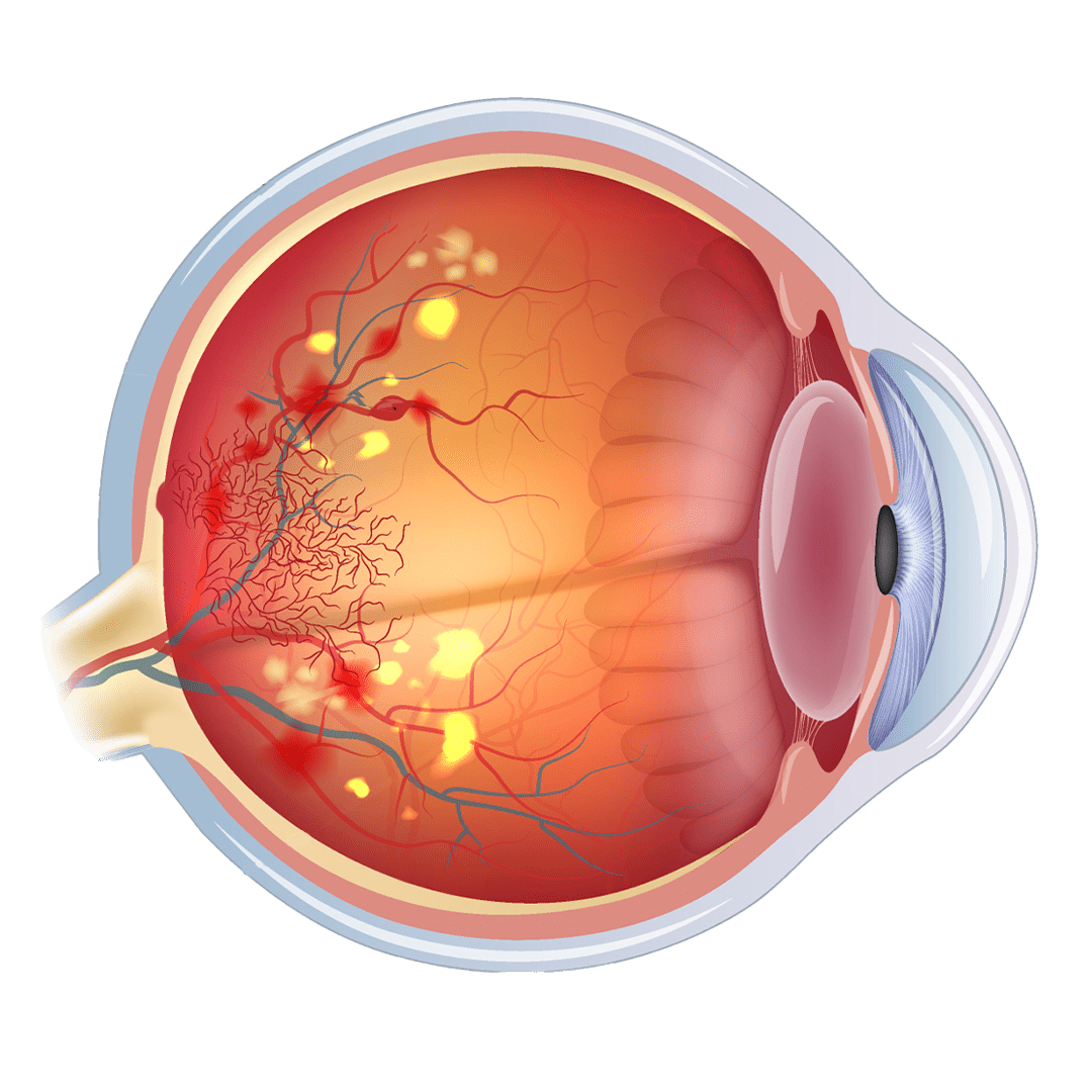 Metamorfopsie: la visione distorta delle linee diritte | Ponticello Eye ...