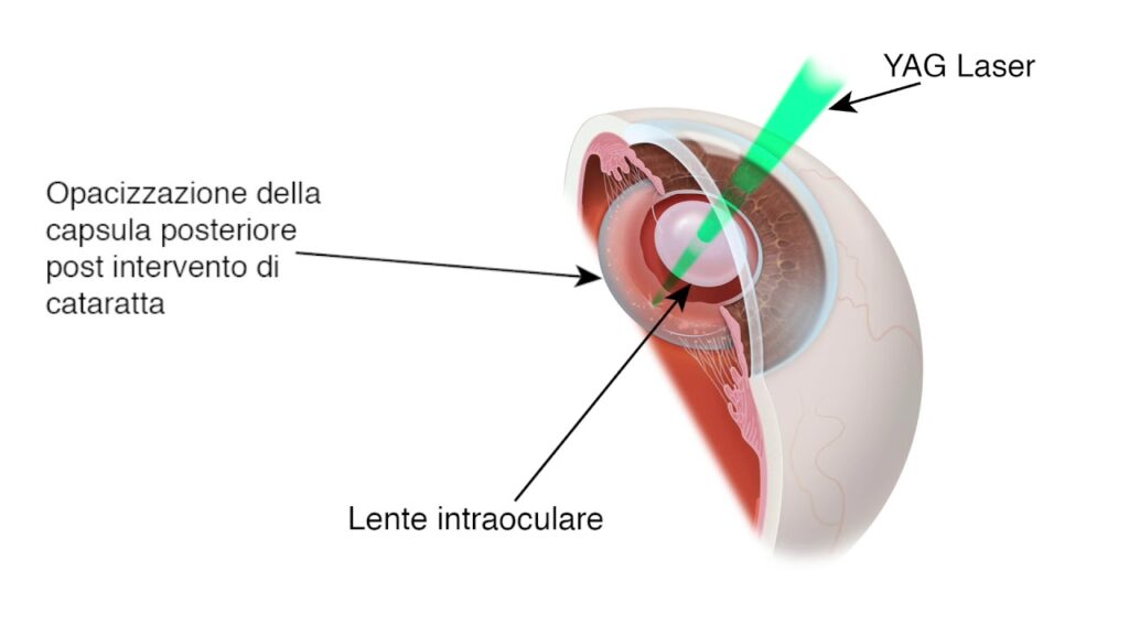 Cataratta secondaria: che cos'è e come si cura | Eye Clinic Massa