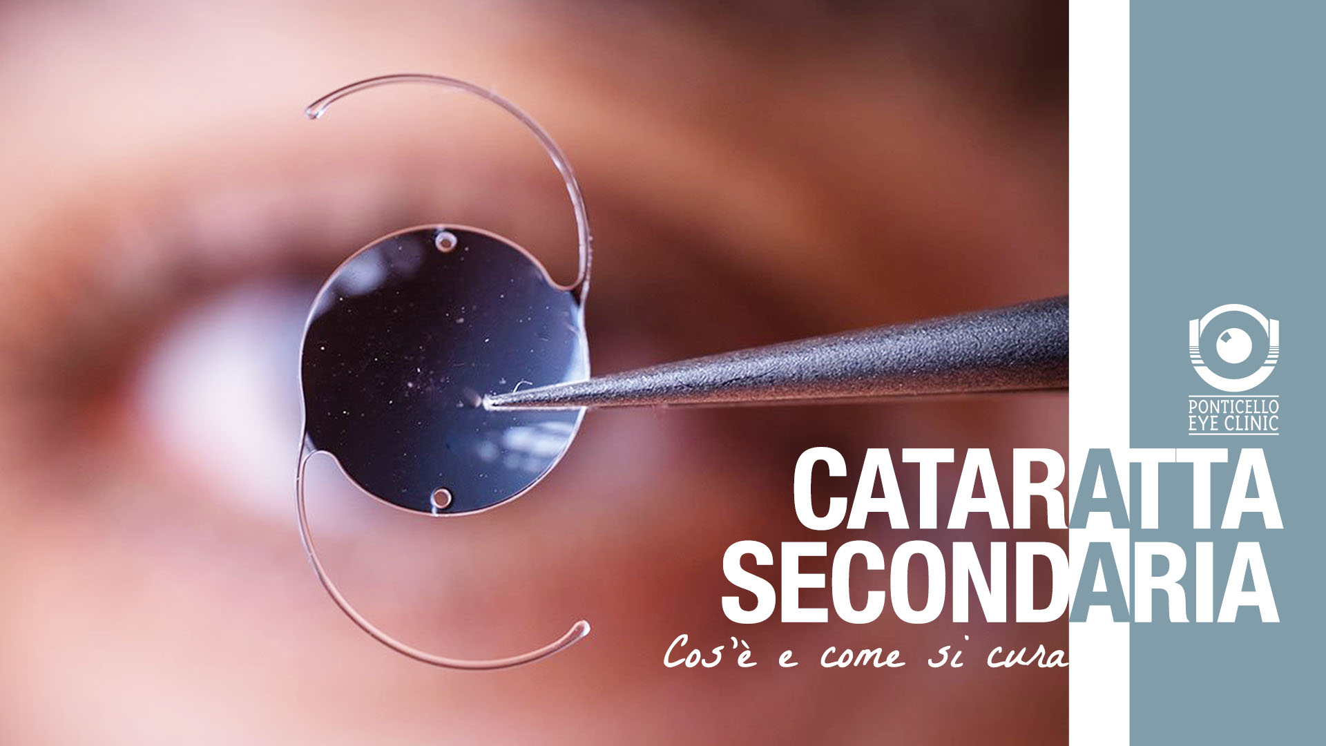 Cataratta secondaria: che cos'è e come si cura | Eye Clinic Massa